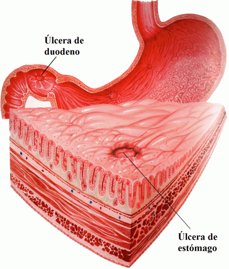 Úlcera Péptica | H. Pylori | Dra. Maria Luiza Queiroz
